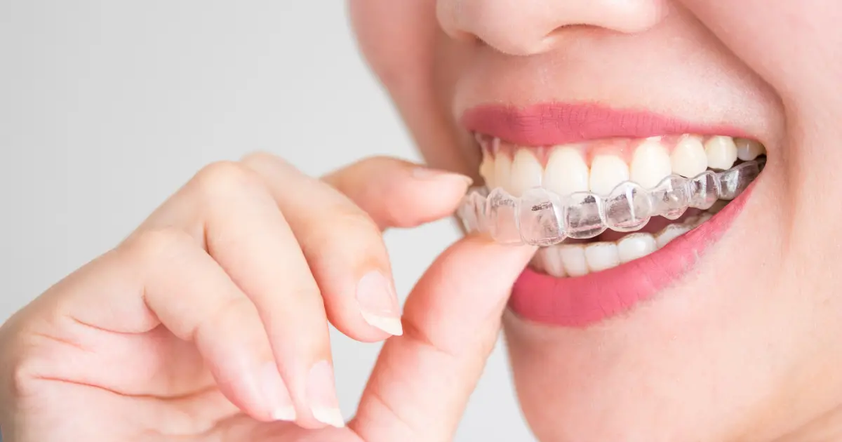 Advantages And Disadvantages of Clear Aligners - Zenit Dent Advantages And Disadvantages of Clear Aligners - Zenit Dent