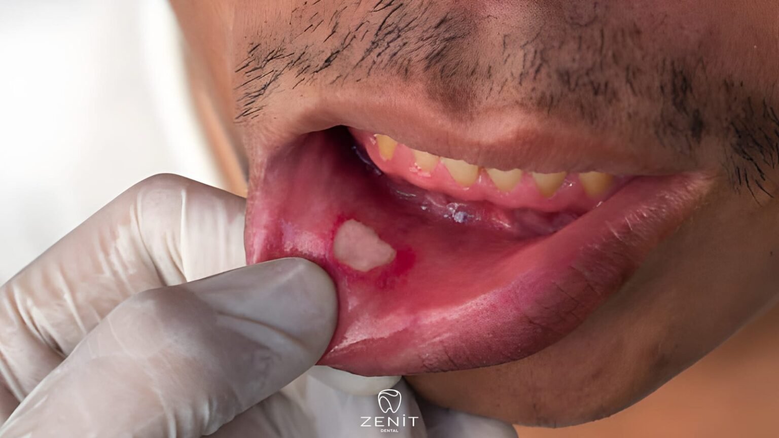 Why Do Mouth Ulcers Occur? - Zenit Dent
