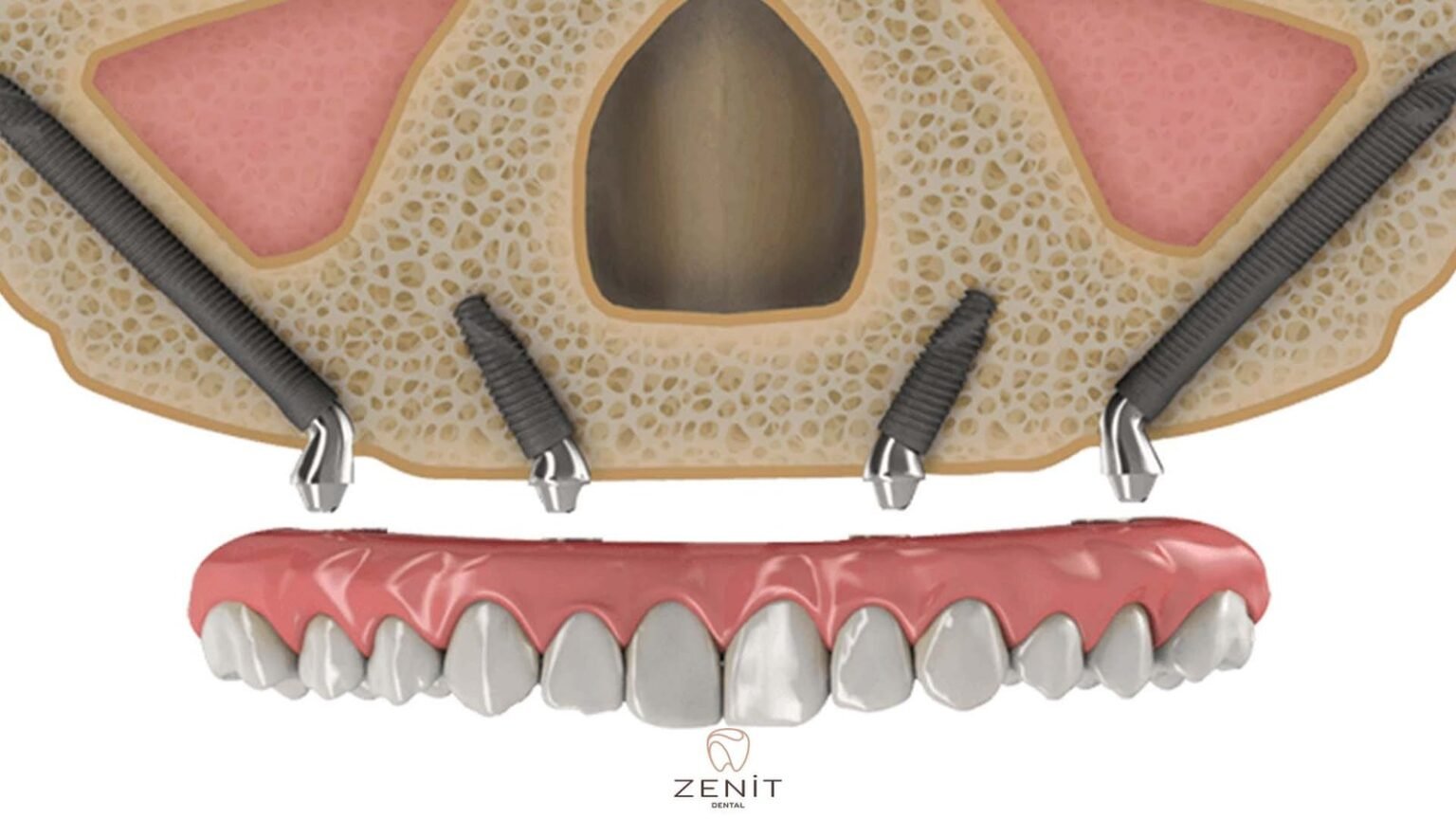 Zygoma Implant - Zenit Dent 2026