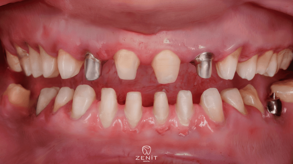 Diş Kesimi Sonrası Şiddetli Ağrı - Zenit Dent 2026